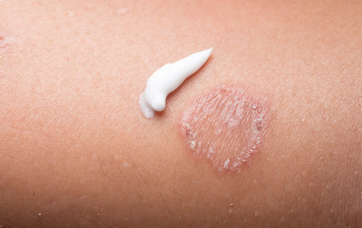 Natural Ways to Treat Ringworm Effectively | The Guide